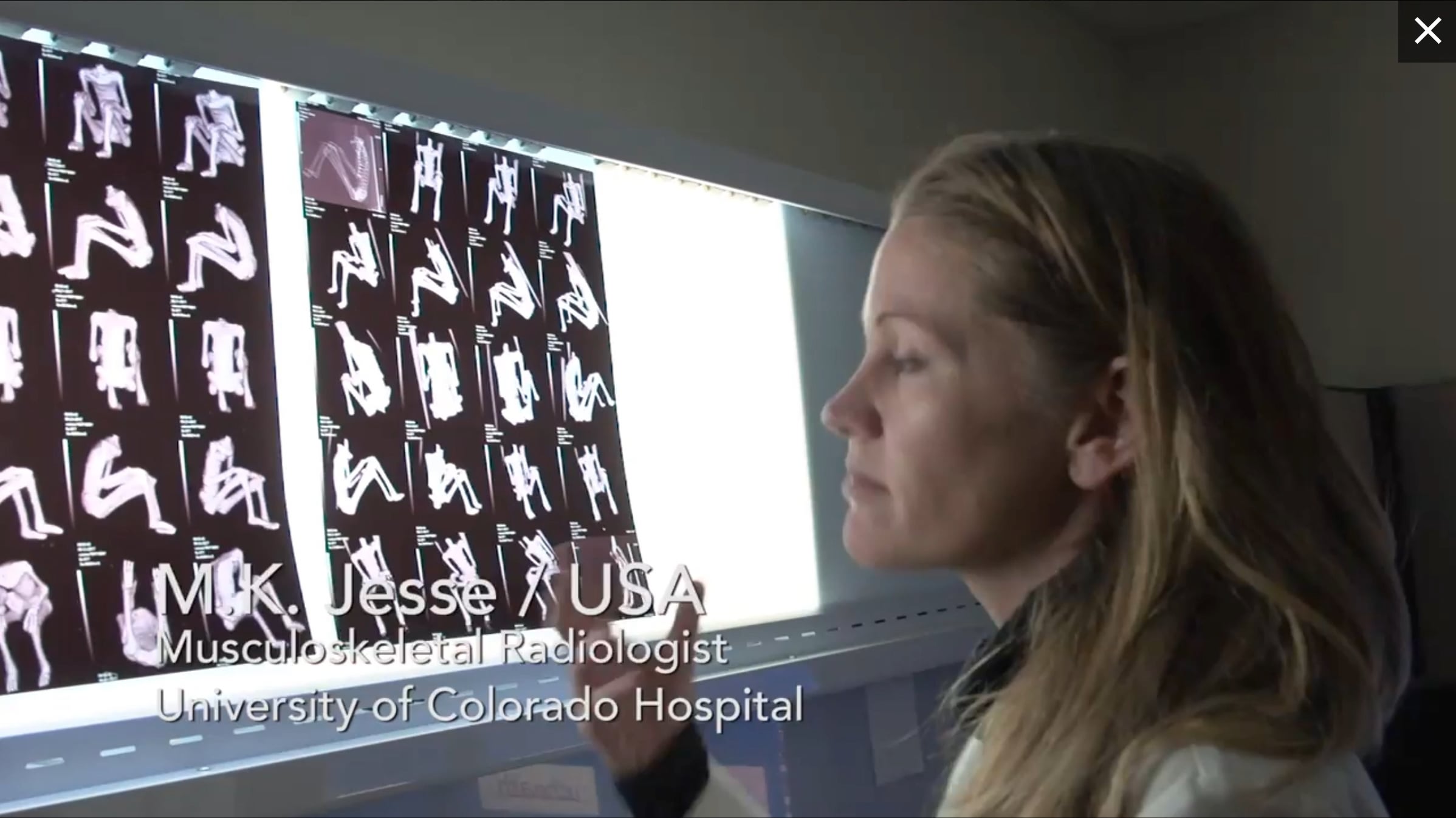 Dr. Mary K. Jesse from University of Colorado Hospital Examines ...