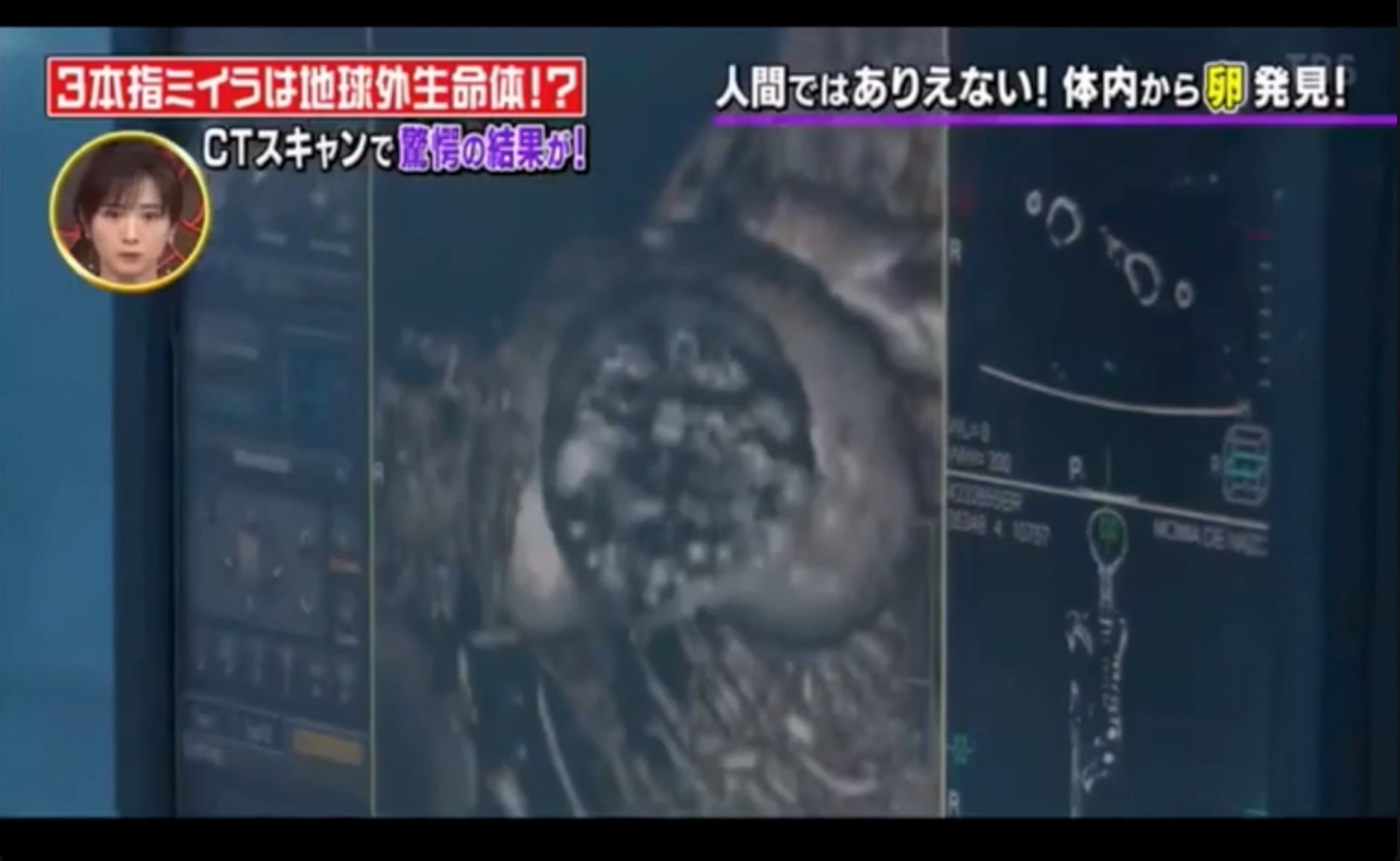 Dr. Katsuyuki Uchino examines CT scans of eggs inside of Nazca Mummy ...