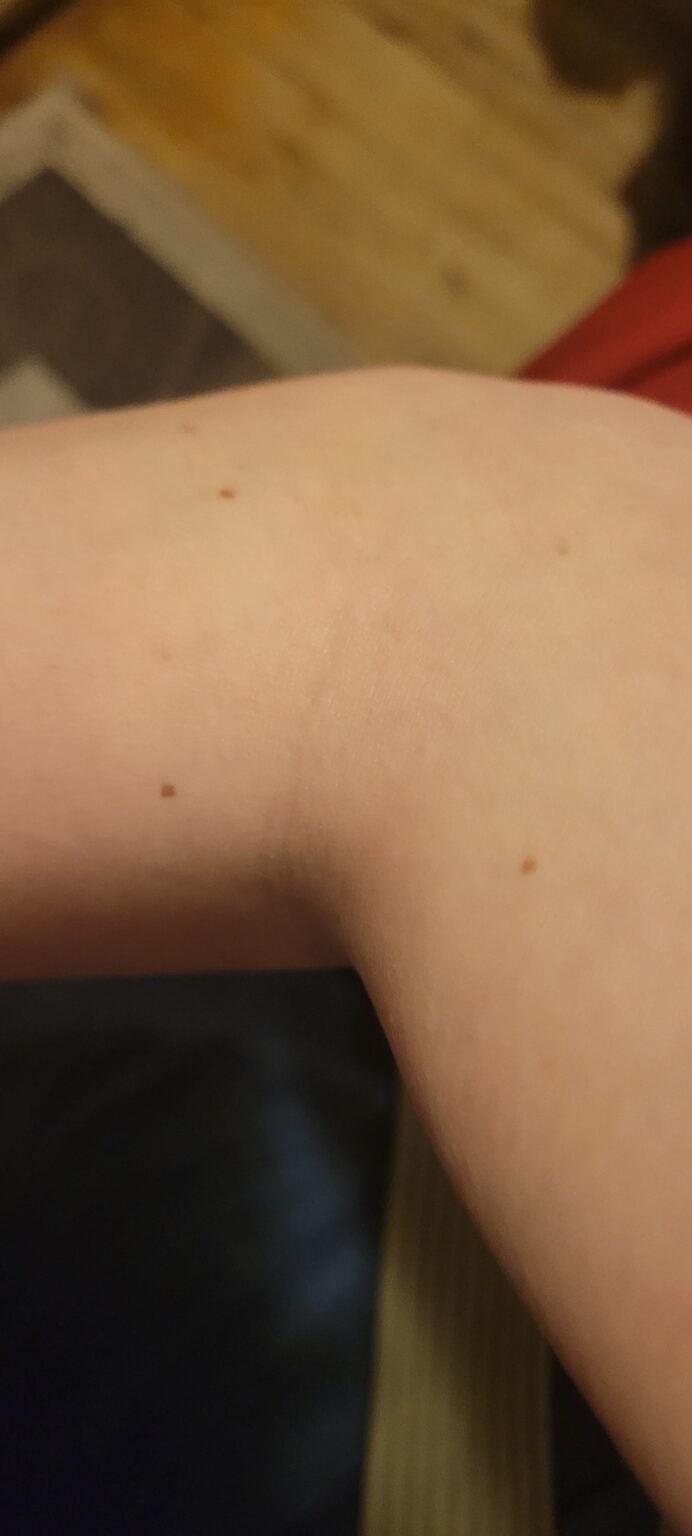 I've have had these four freckles appear on my arm - UFO FEED