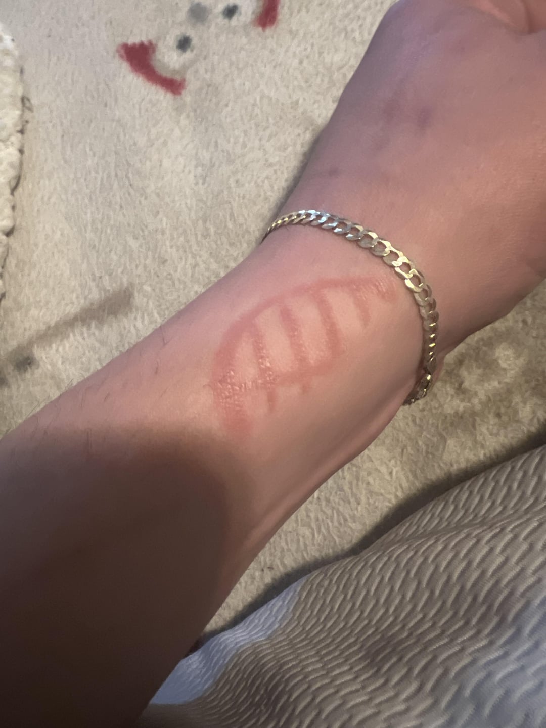 Woke up with weird burn marks that dont hurt and appeared overnight- feels like tattoo – UFO FEED