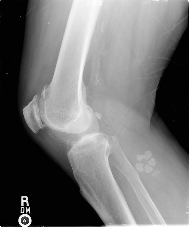 In 2012, a knee injury required Terry Lovelace to get an X-ray which ...