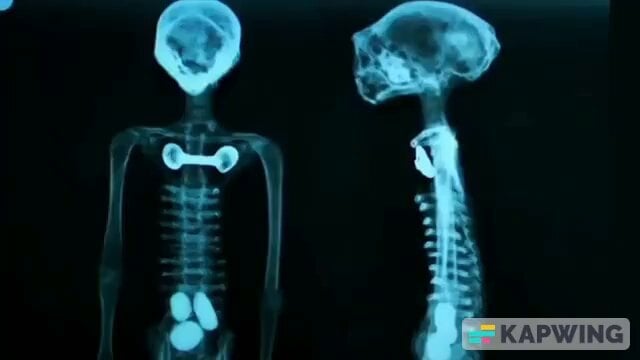 A doctor examines the undeveloped eggs of the nazca mummies - UFO FEED
