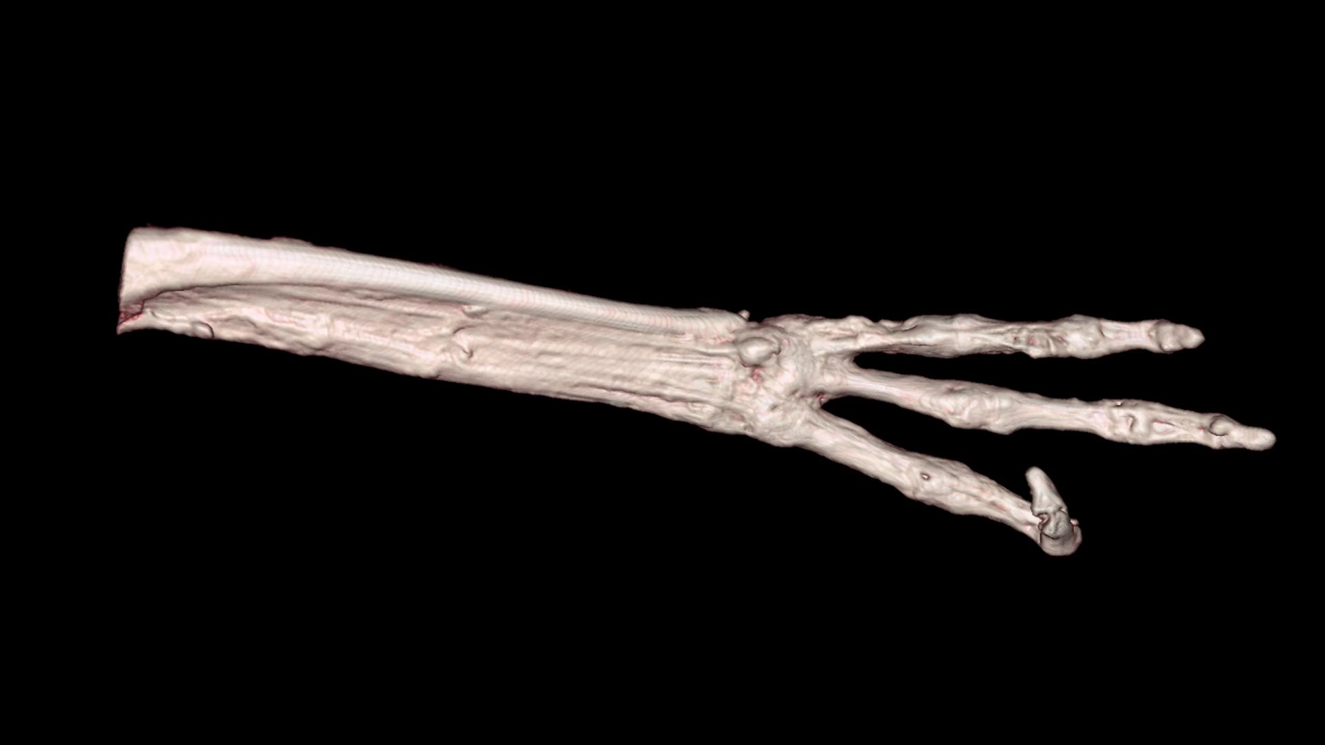 A video of Montserrat right hand and her implant directly made from her ...