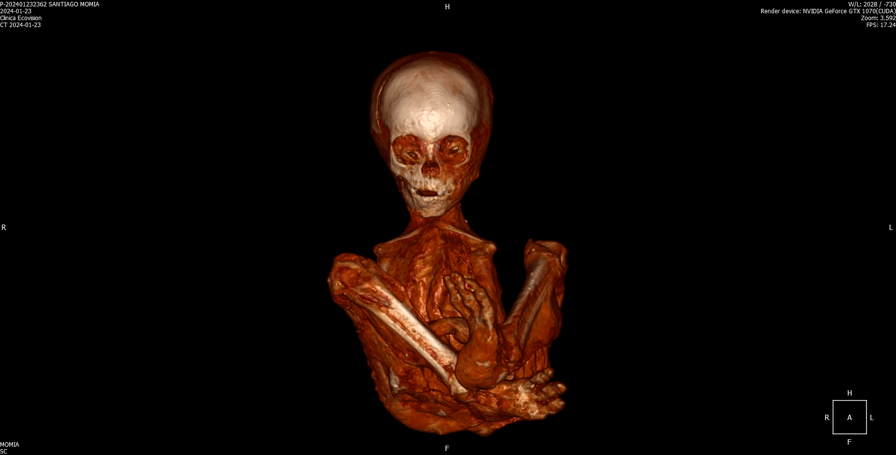 Medical Scan of Santiago: A 3-Foot-Tall Tridactyl Being with Gray Skin ...